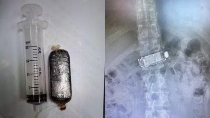 Preso engole celular e precisa passar por cirurgia | DIARINHO